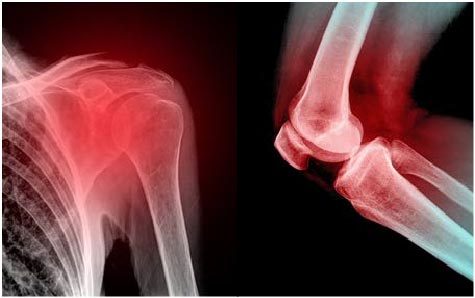 Conventional Arthrography - FV Hospital