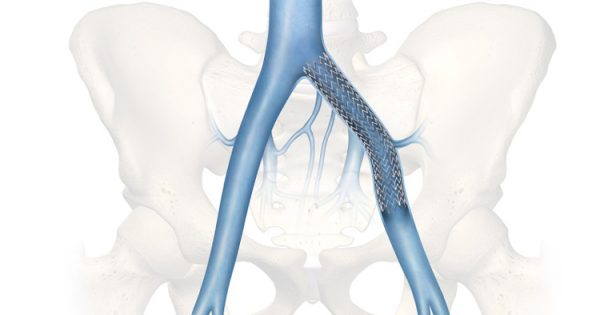 Treatment for deep vein thrombosis (DVT) with endovenous intervention ...