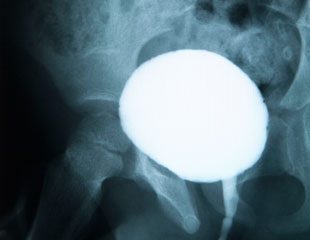 Children’s Voiding Cysto-Urethrogram - FV Hospital