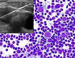 Chọc hút bằng kim nhỏ để khảo sát các bệnh lý ở đầu và cổ - Bệnh Viện FV