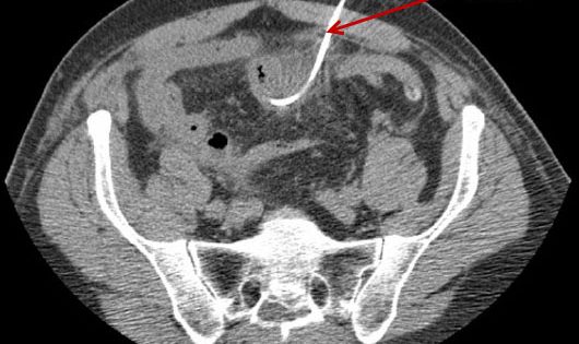 Percutaneous Abscess Drainage - FV Hospital