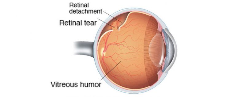 Retinal Detachment - FV Hospital