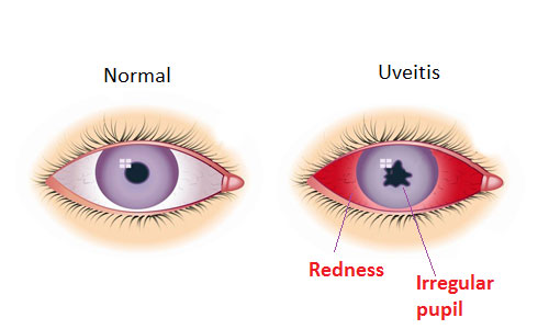 Uveitis FV Hospital Uveitis FV Hospital