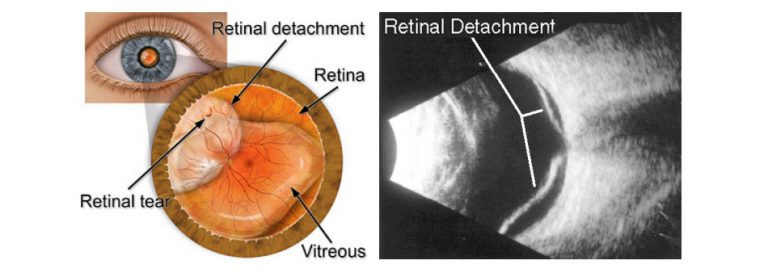 Retinal Detachment - FV Hospital