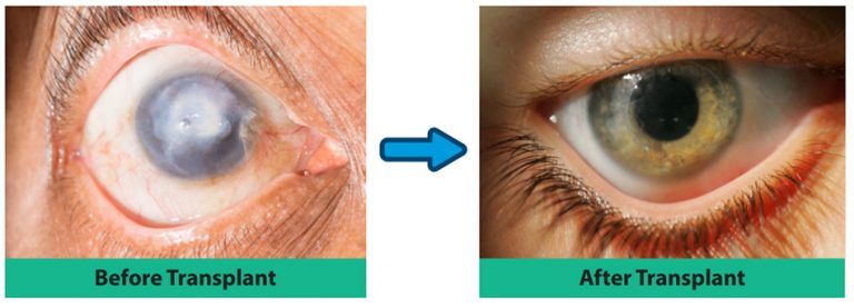 Corneal Transplantation - FV Hospital