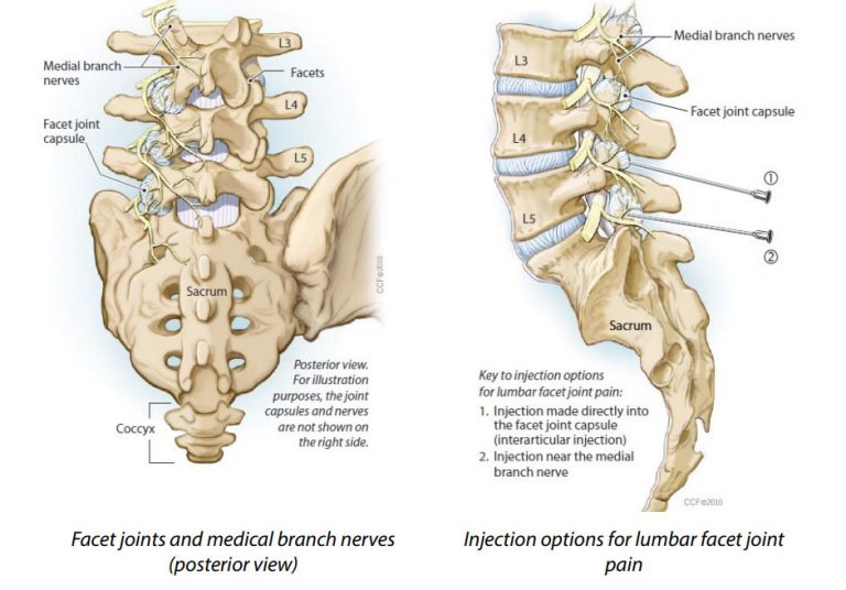 Facet Joint Injections for the Treatment of Pain - FV Hospital