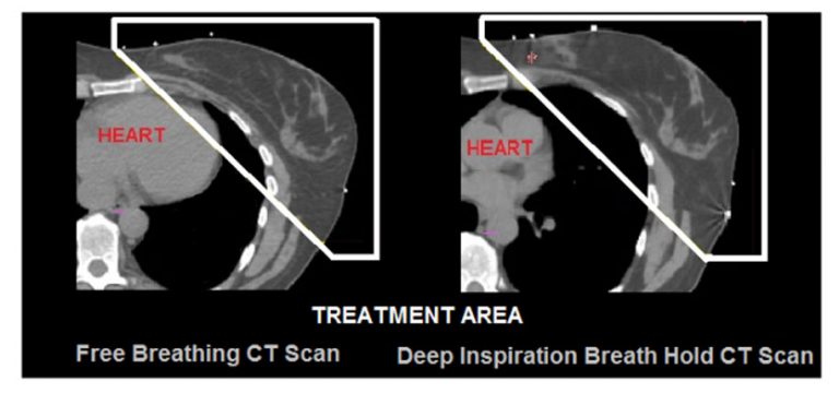 Deep Inspiration Breath Hold and Active Breathing Coordinator - FV Hospital