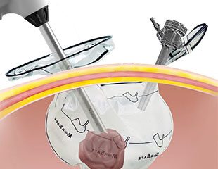 Công nghệ nội soi ổ bụng hiệu quả