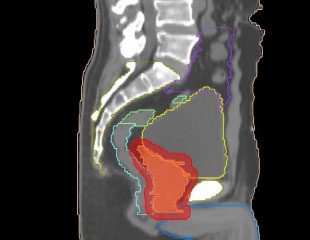 Bowel and Bladder Preparation for Radiotherapy to the Pelvis - FV Hospital
