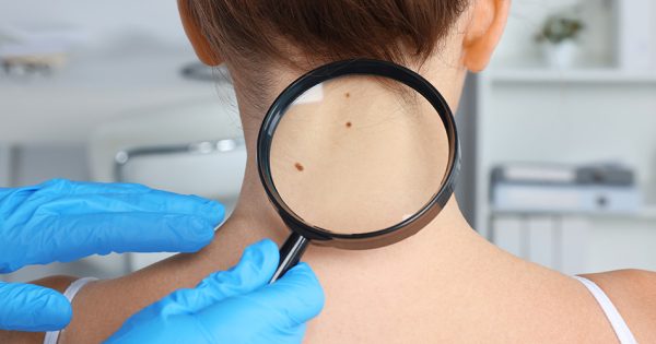 Early detection of skin cancer with FotoFinder Bodystudio automated ...