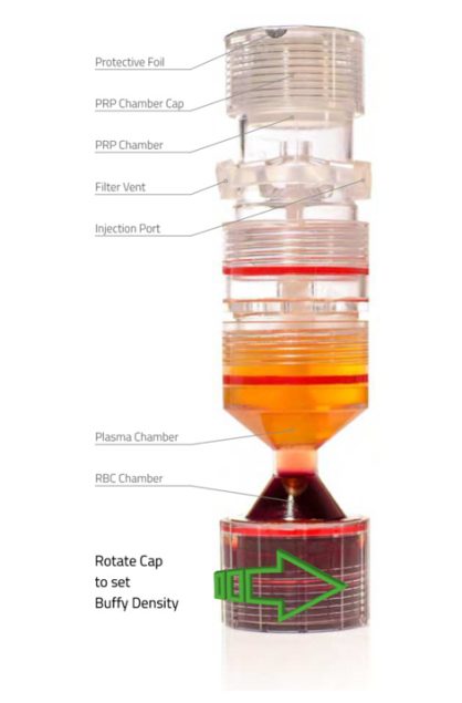 Platelet-Rich Plasma (PRP) Therapy - FV Hospital