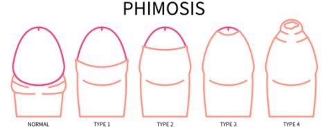 Adult Circumcision - FV Hospital